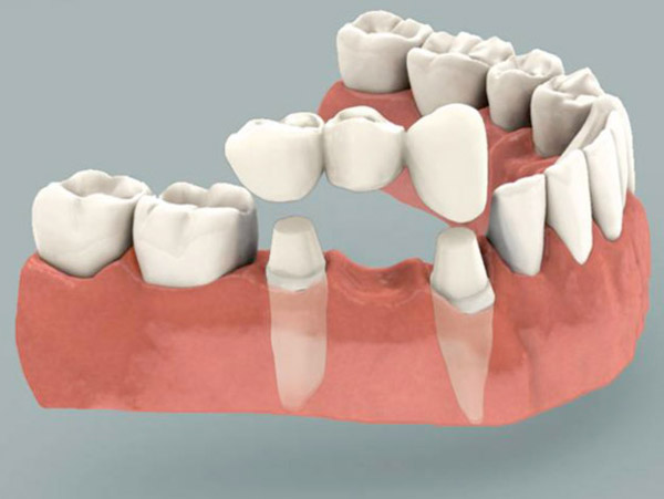 Crowns and Bridges - Mosman Dentistry, Mosman Dentists