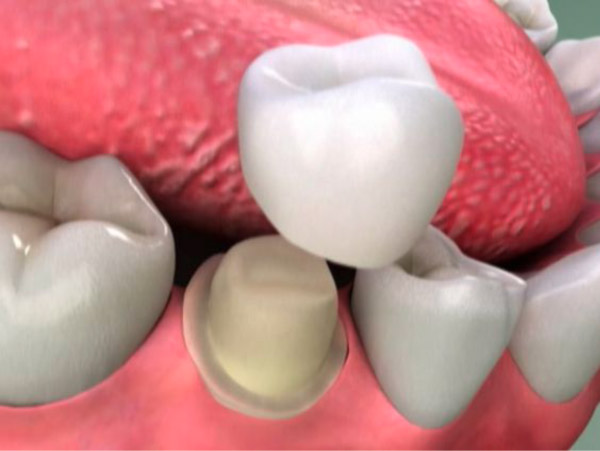 Crowns and Bridges - Mosman Dentistry, Mosman Dentists